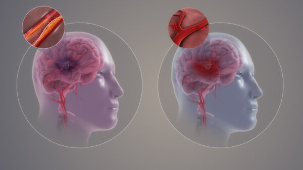 Seberapa Besar Efek Stroke pada Tubuh? | iReborn